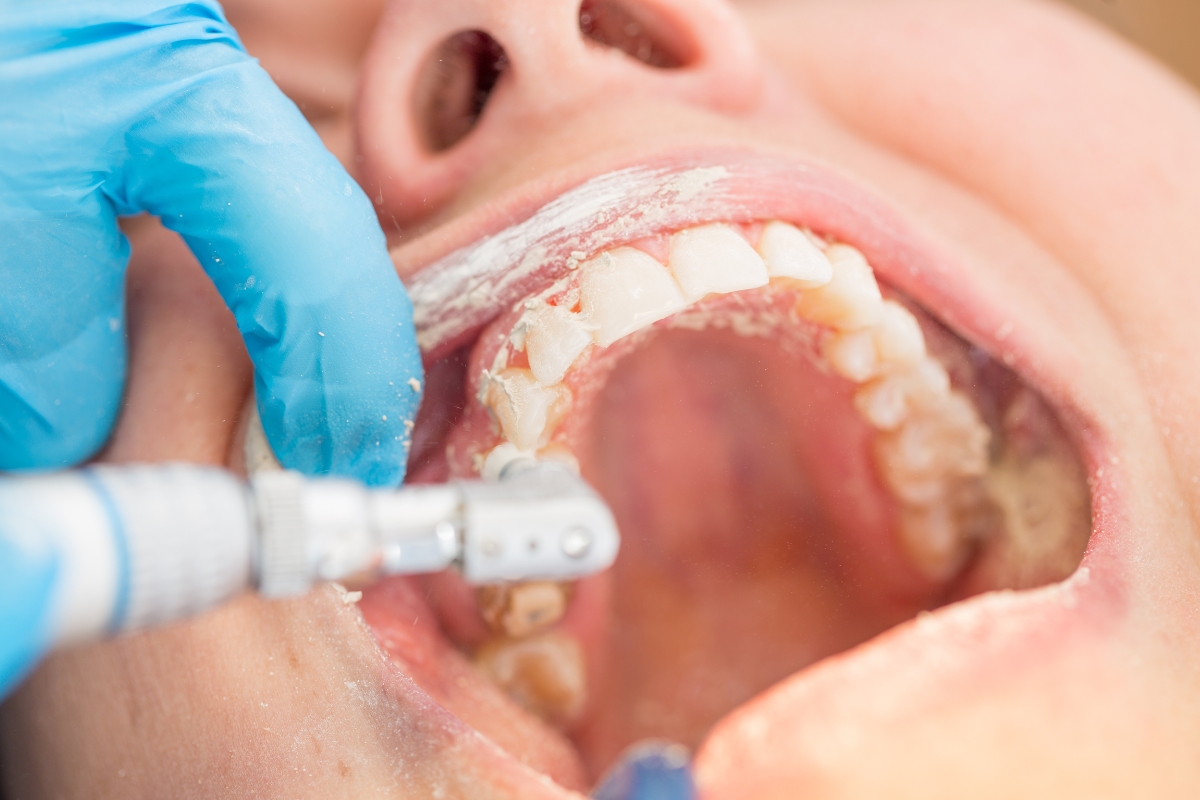 Types of Tooth Extractions: Simple vs. Surgical
